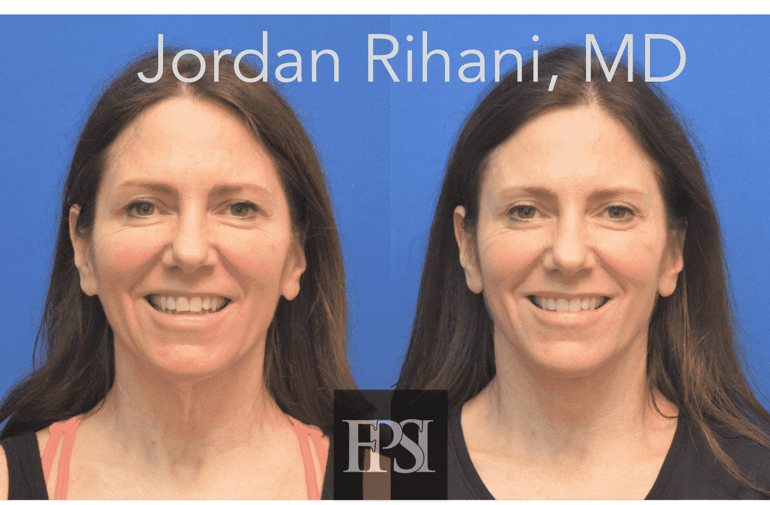 facelift3829 - Facial Plastic Surgery Institute