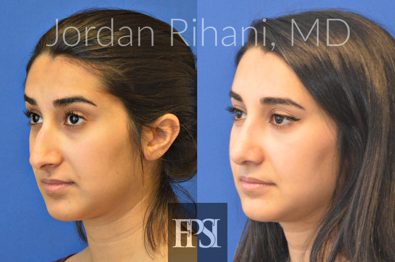 RHINO_3 - Facial Plastic Surgery Institute