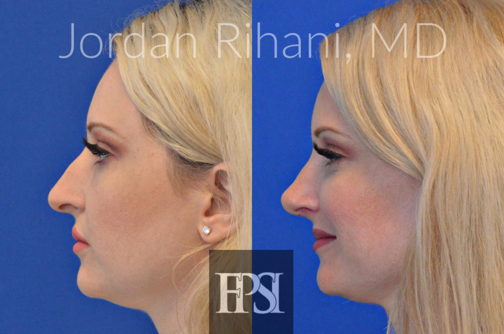 RHINO_A.A2 - Facial Plastic Surgery Institute