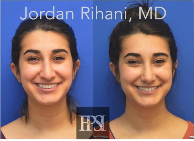 Rhinoplasty - Facial Plastic Surgery Institute