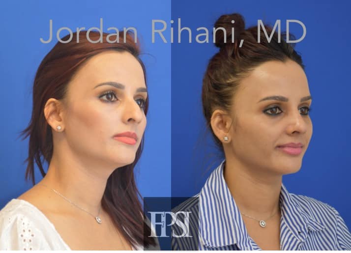 Rhinoplasty - Facial Plastic Surgery Institute