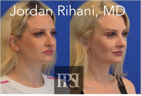 rhinoplasty2787 - Facial Plastic Surgery Institute