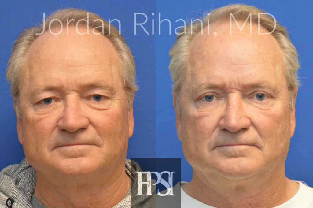 BLEPHAROPLASTY_R.L - Facial Plastic Surgery Institute