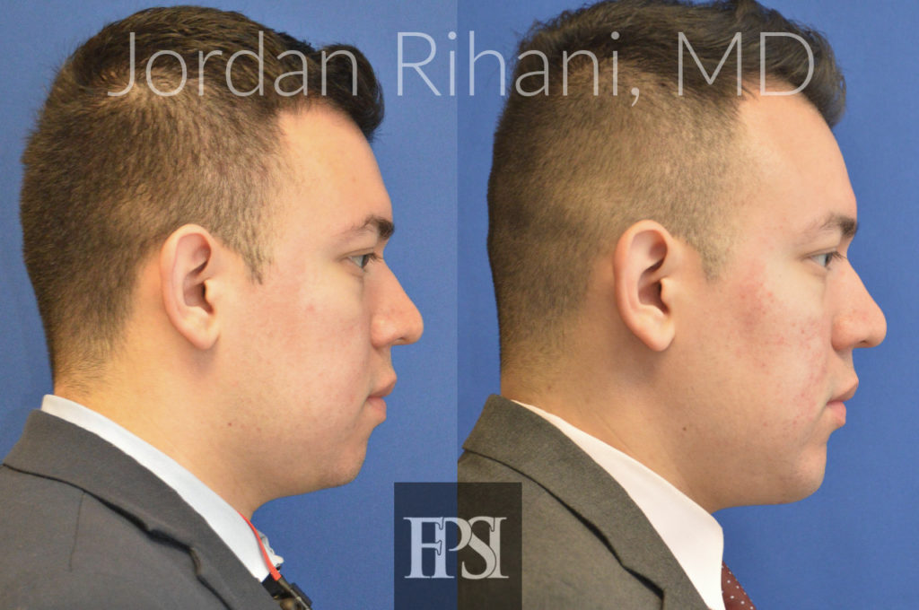 Chin.E.M2 - Facial Plastic Surgery Institute