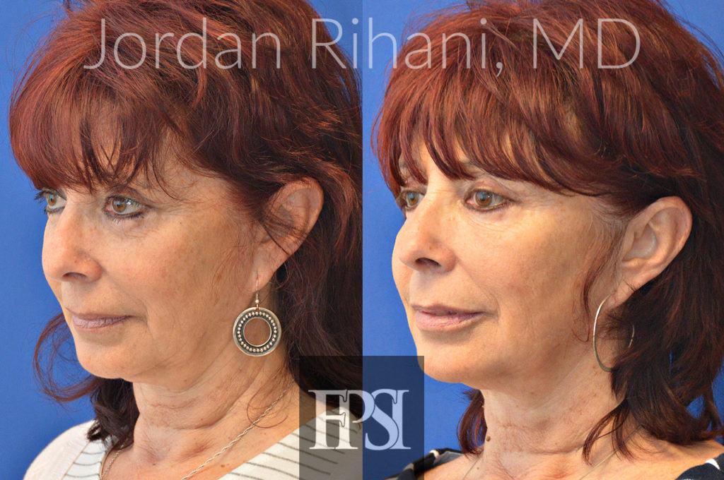 FILLER_S.M3 - Facial Plastic Surgery Institute