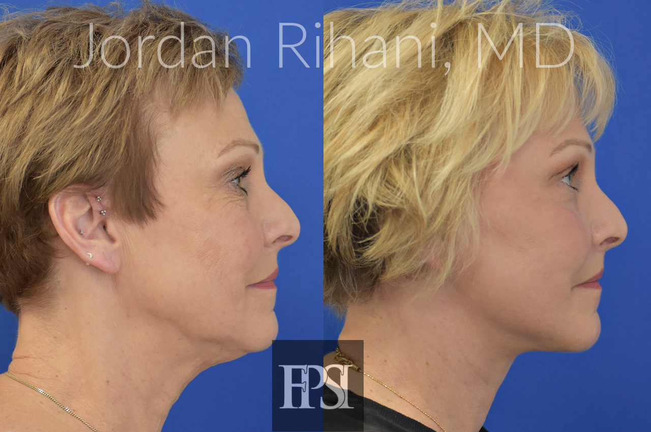 NEWTCN_C.H2 - Facial Plastic Surgery Institute