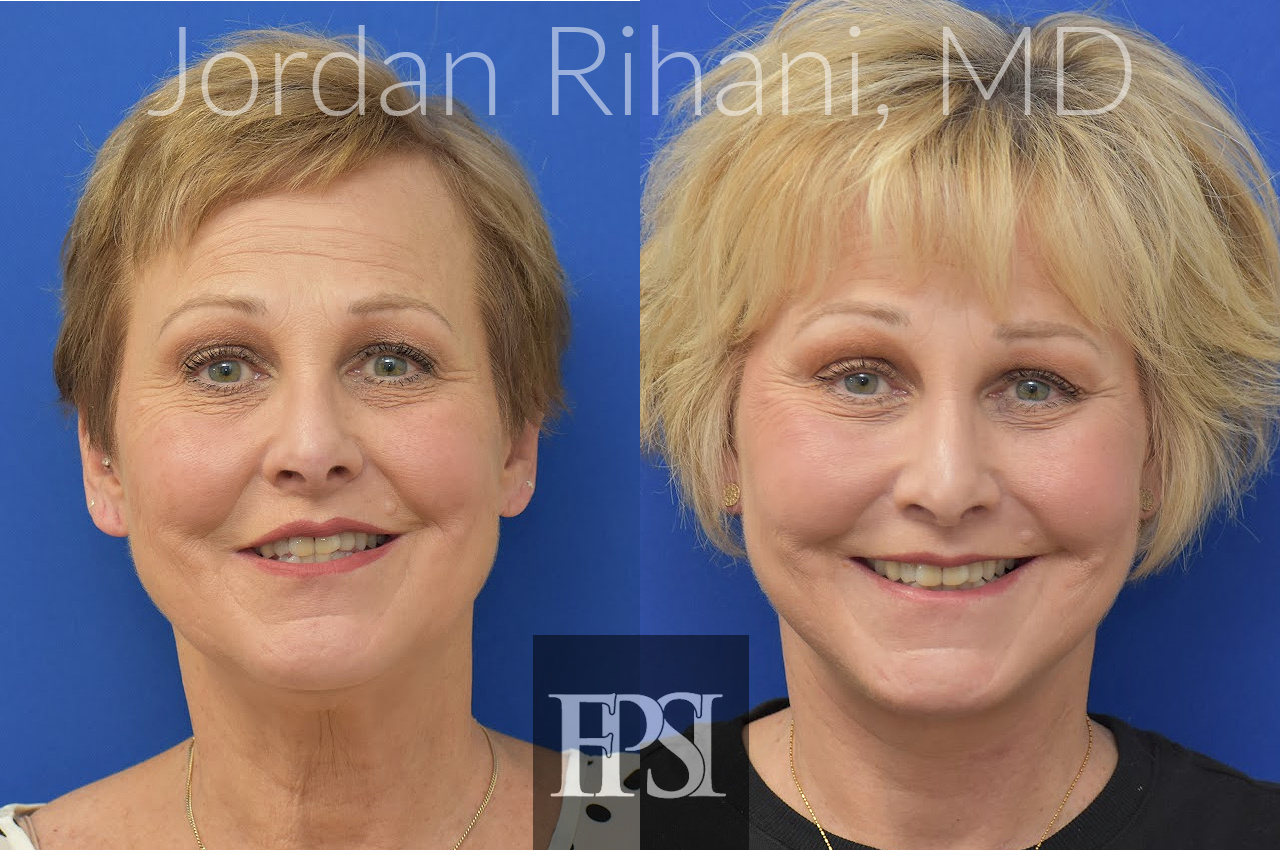 NEWTCN_C.H3 - Facial Plastic Surgery Institute