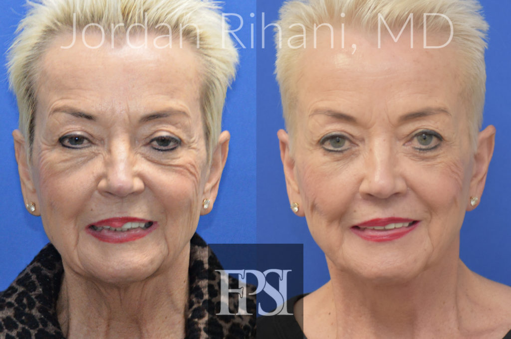 NEWTCN_T.E2 - Facial Plastic Surgery Institute