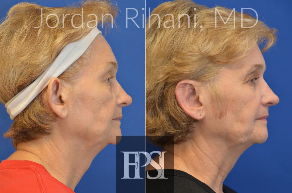 OTOPLASTY_P.C2 - Facial Plastic Surgery Institute