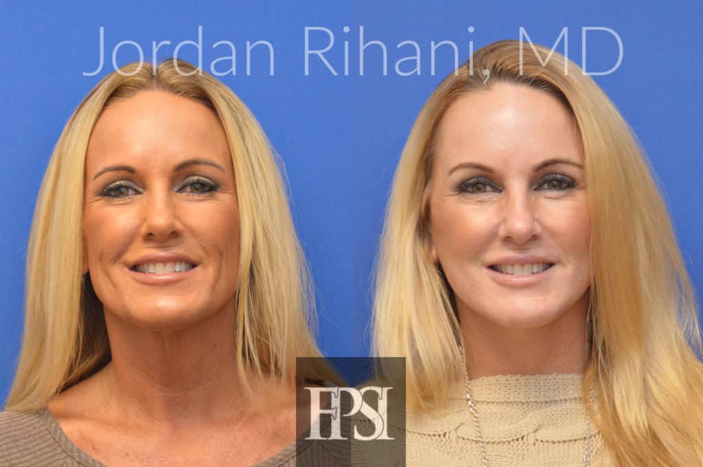 facelift8283 - Facial Plastic Surgery Institute