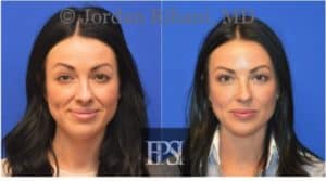 botoxbeforeafter - Facial Plastic Surgery Institute