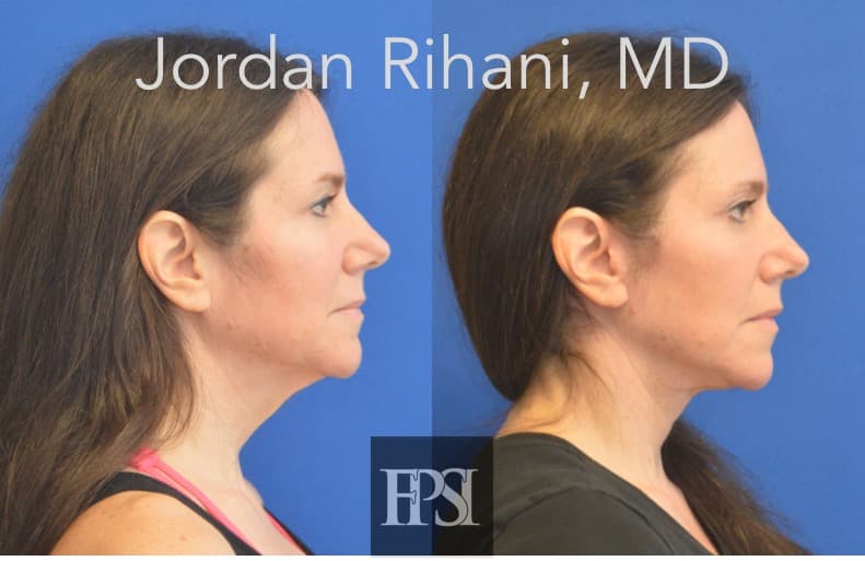 facelift2593 - Facial Plastic Surgery Institute