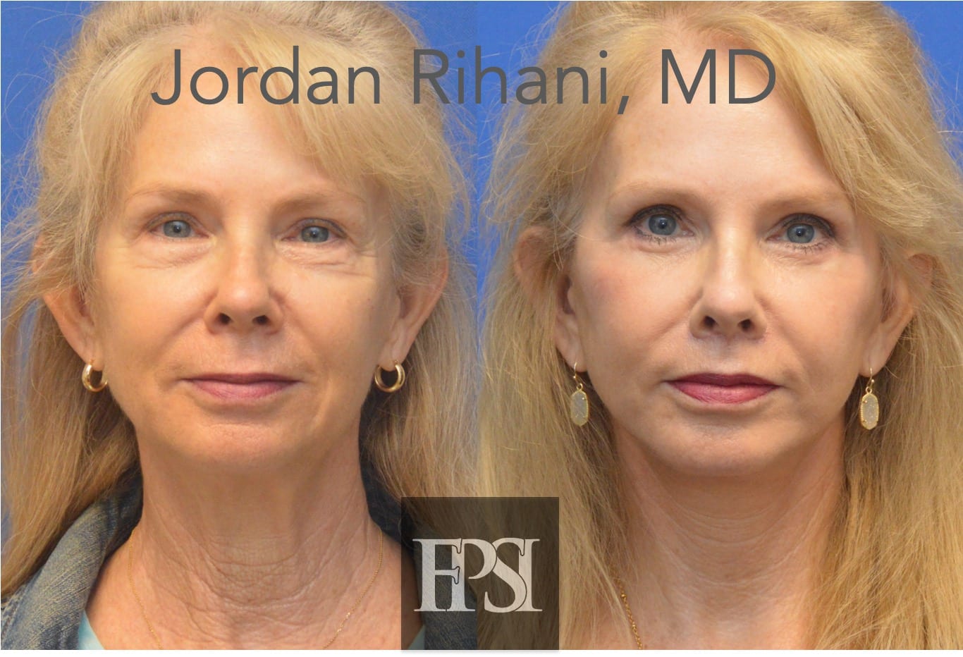 facelift301 - Facial Plastic Surgery Institute