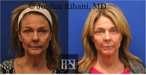 faceliftfront-2 - Facial Plastic Surgery Institute
