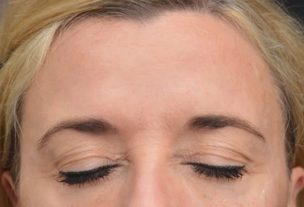 The Botox Browlift - Facial Plastic Surgery Institute