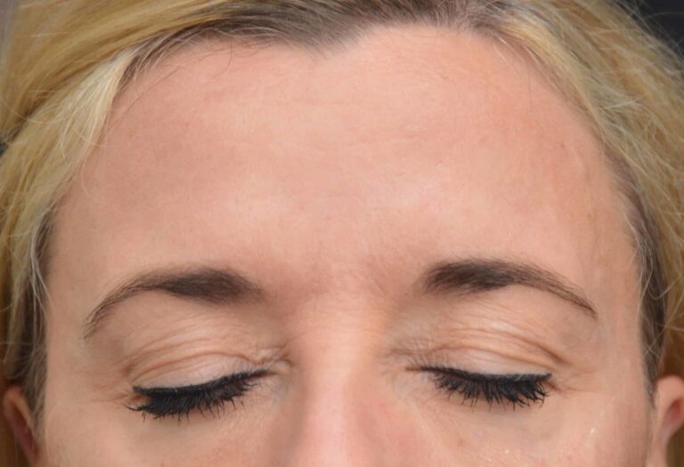 The Botox Browlift - Facial Plastic Surgery Institute