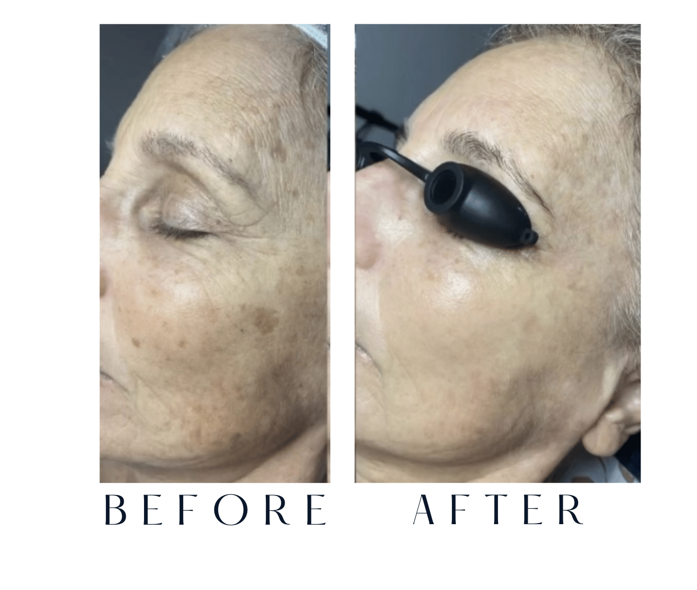 Laser Season: A Comprehensive Guide to Pre-Treatment and Understanding ...